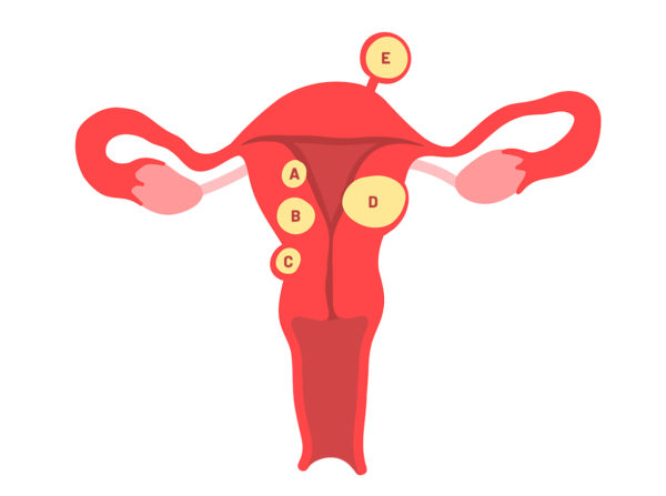 Was sind Myome? Symptome, Behandlungsoptionen und mehr