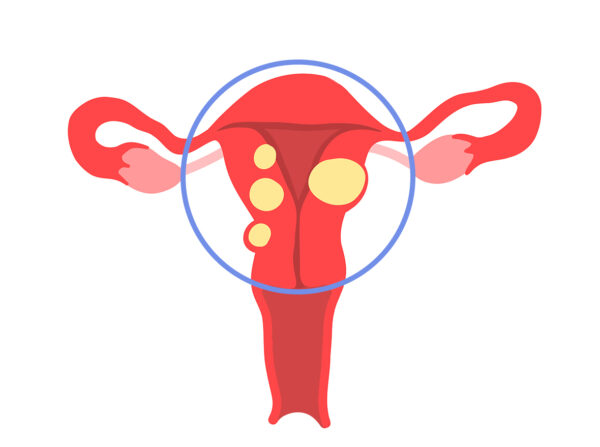 Gebärmutterentfernung: Vor- und Nachteile der Hysterektomie