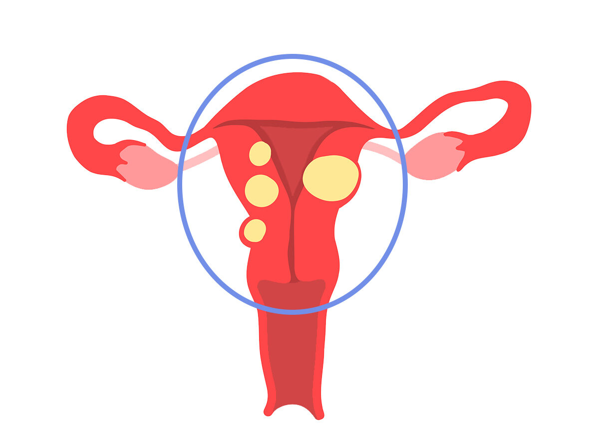 Gebärmutterentfernung: Vor- und Nachteile der Hysterektomie